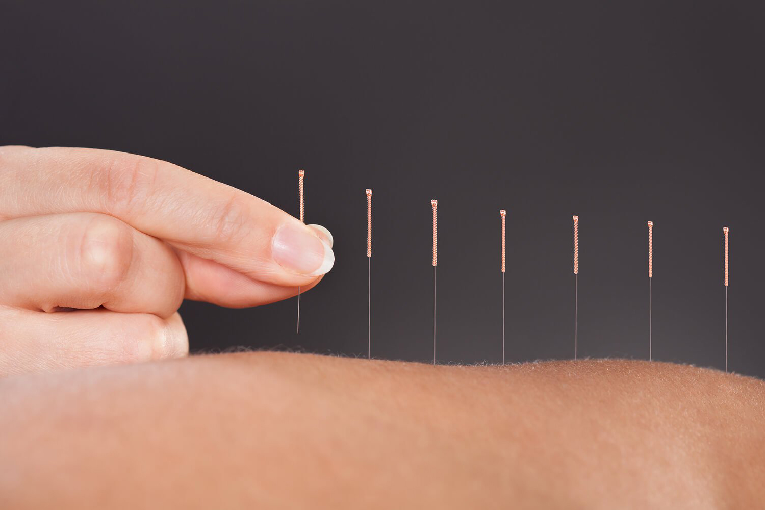 Acupuncture Services – Herbphd